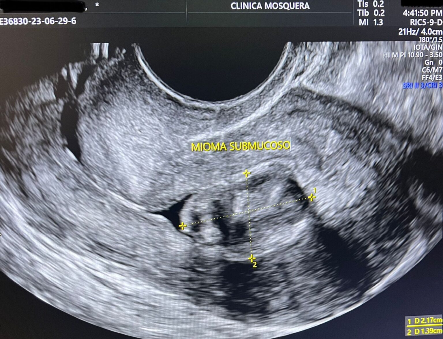 HISTEROCOPÍA POR MIOMAS EN LA CAVIDAD UTERINA - Dr. Jaime Mosquera Vallejo